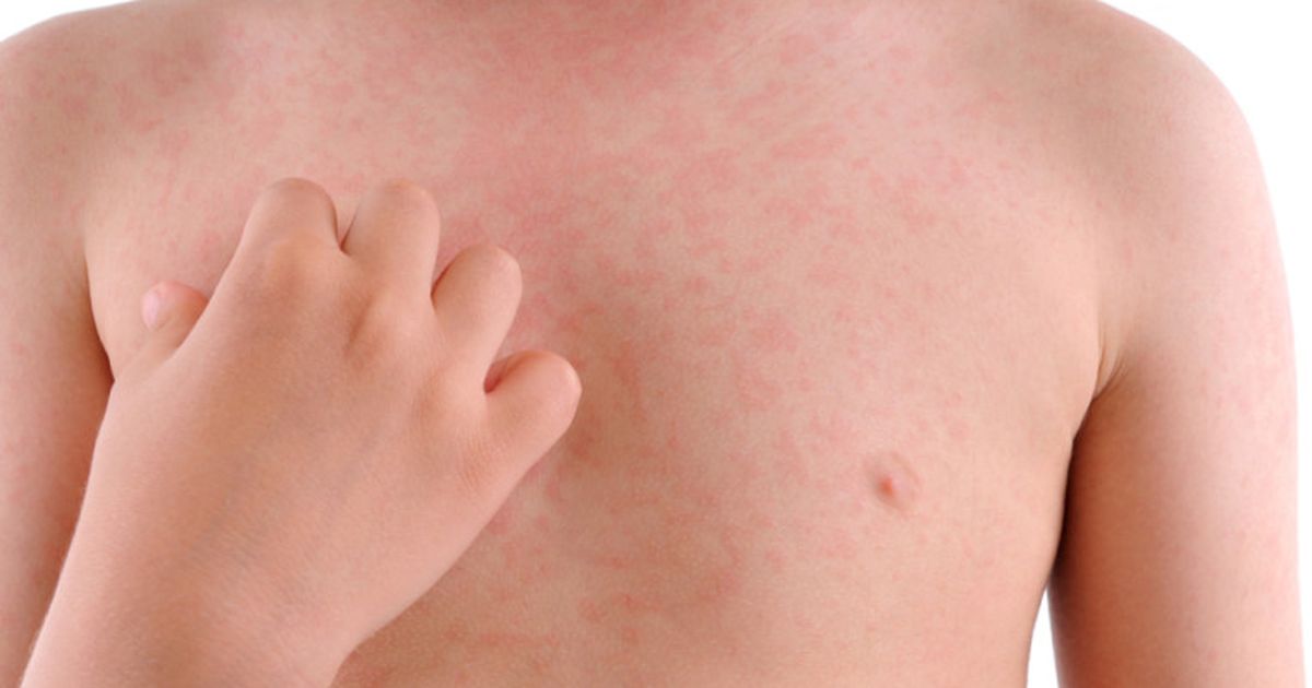 Hauterkrankung: Ringelröteln: Allgemeine Information | BUNTE.de