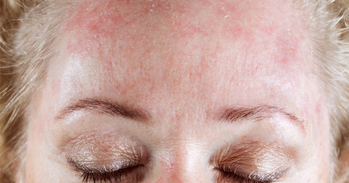 Rötungen: Das sind die Symptome von Rosazea | BUNTE.de