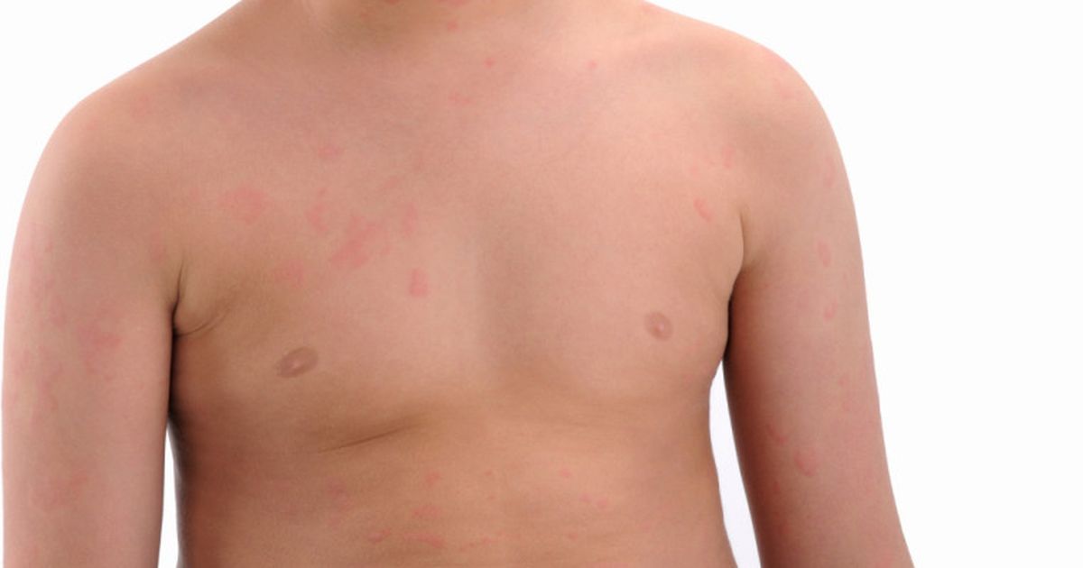 Infektionskrankheiten: Ringelröteln: Therapie | BUNTE.de