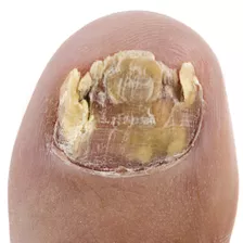 nagelpilz-pilzerkrankungen-der-n-gel-erkennen-behandeln-und-vorbeugen