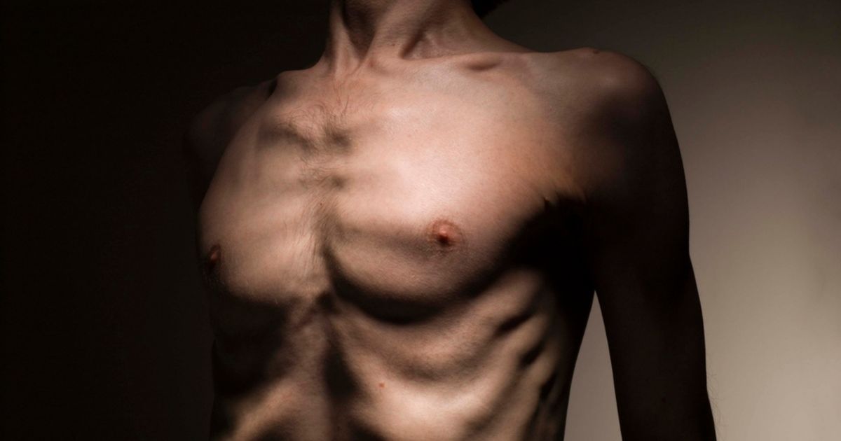 Leber: Symptome einer Leberzirrhose | BUNTE.de