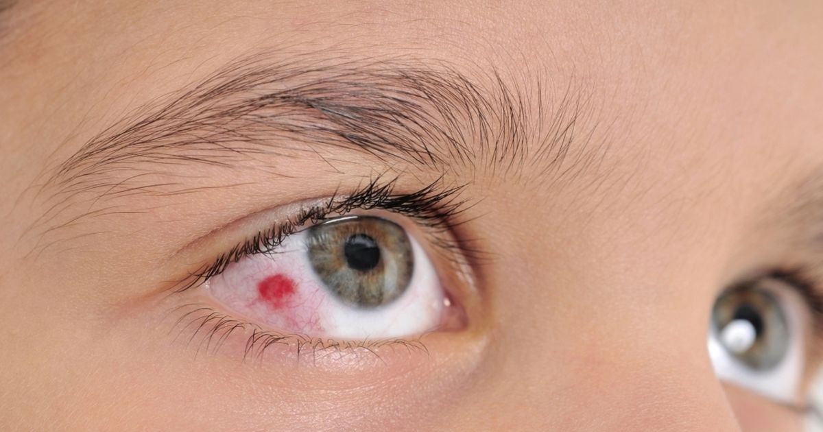 Augenkrankheiten: Bindehautentzündung: Die häufigsten Symptome | BUNTE.de