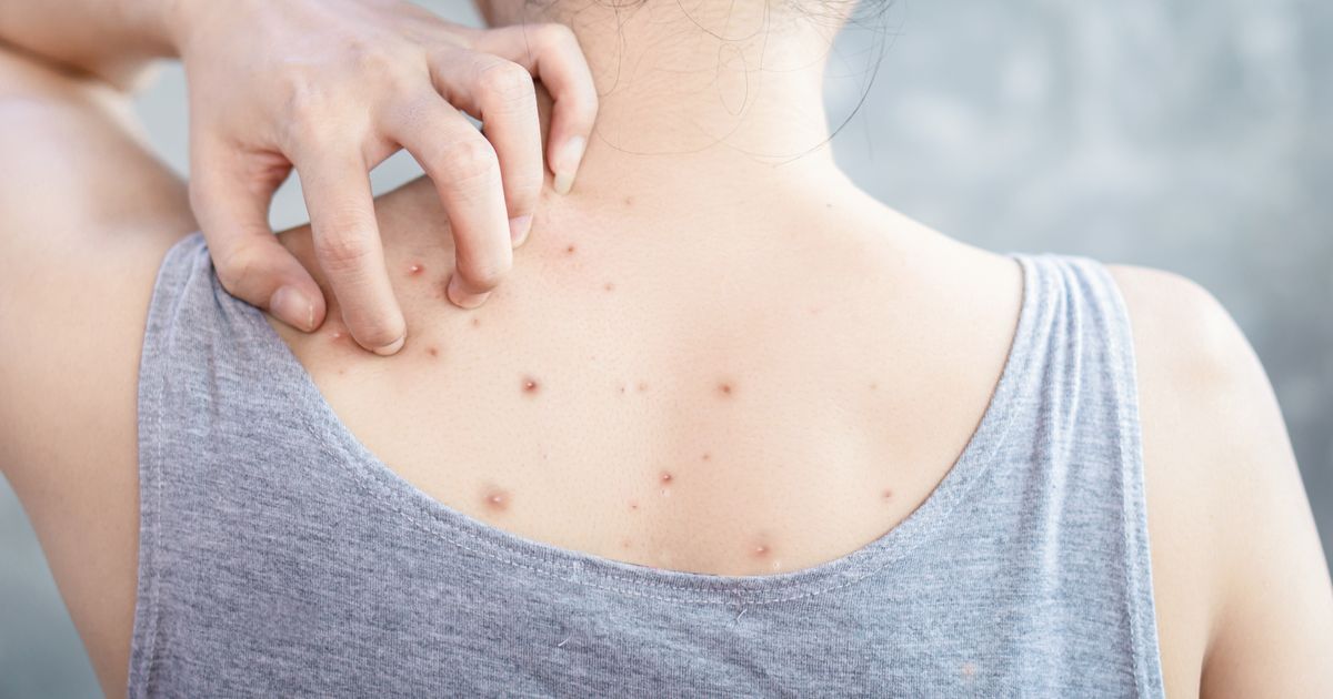 Hautprobleme bei großer Hitze: So bekämpfst du wirkungsvoll Hitzepickel ...